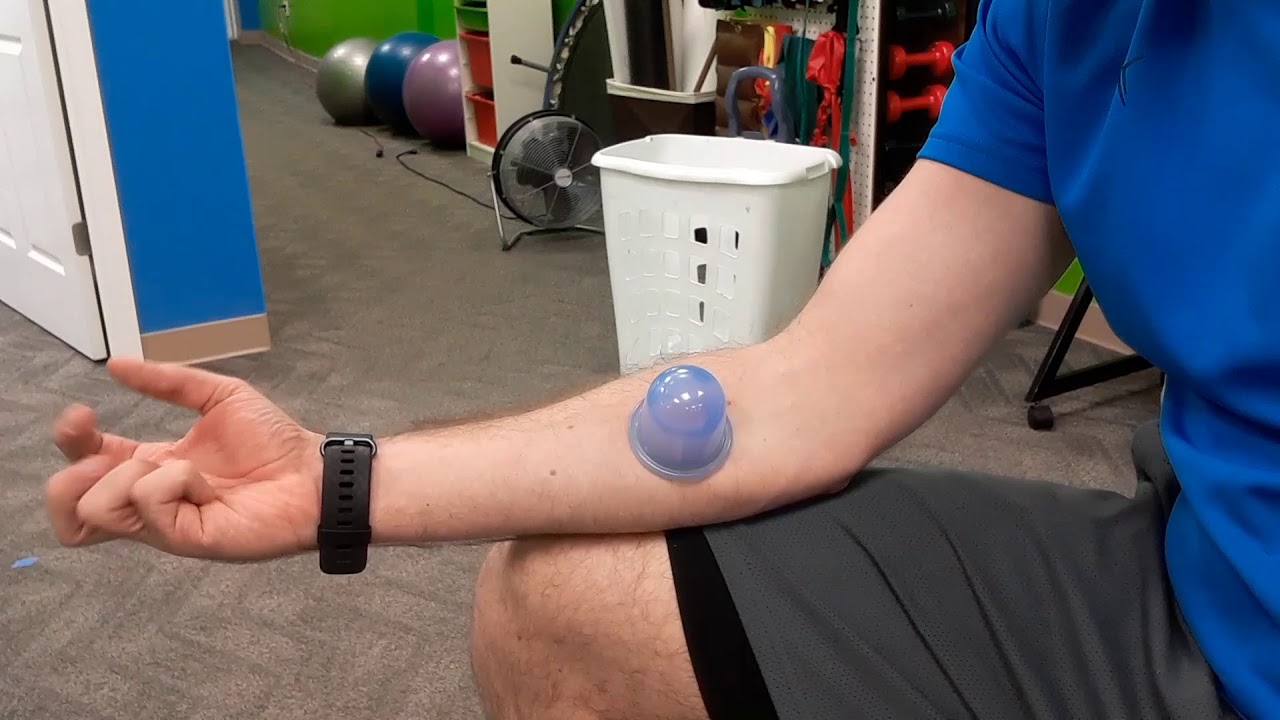 Cupping Forearm - YouTube