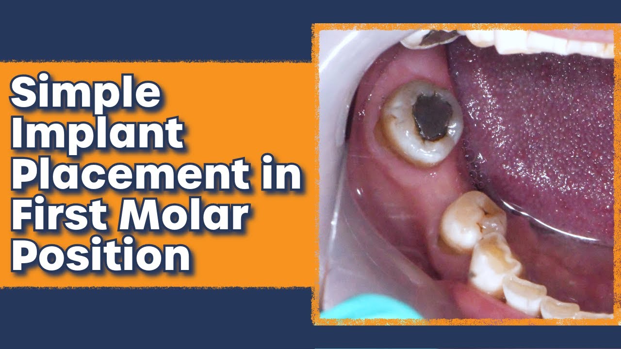 Simple Implant Placement In First Molar Position - YouTube