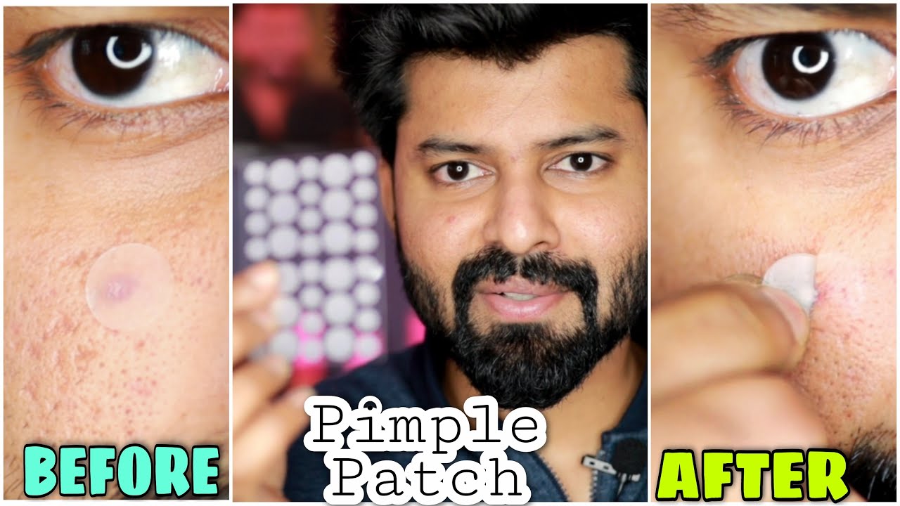 Pimple Patch Really Worked | One day Acne Control | Tamil | English ...