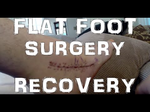 Flat Feet Surgery Recovery 7 Weeks In: Showing Off Scars - YouTube