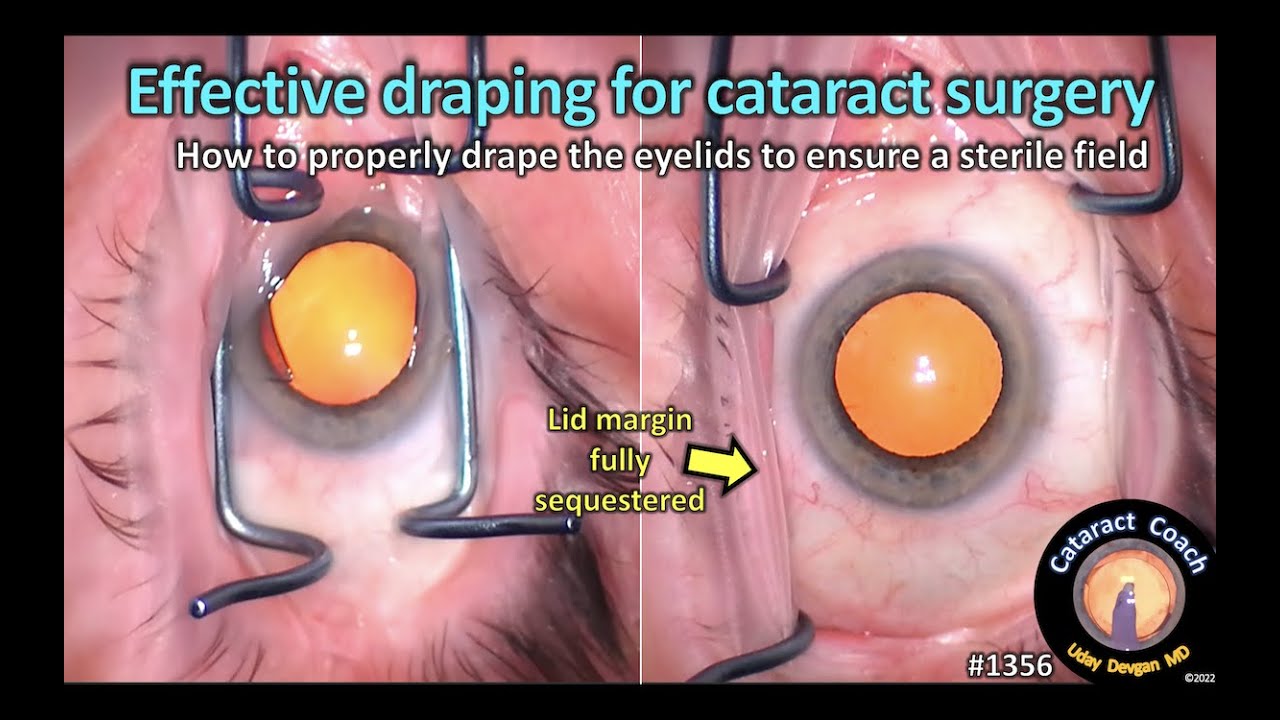 CataractCoach 1356: effective draping for cataract surgery - YouTube