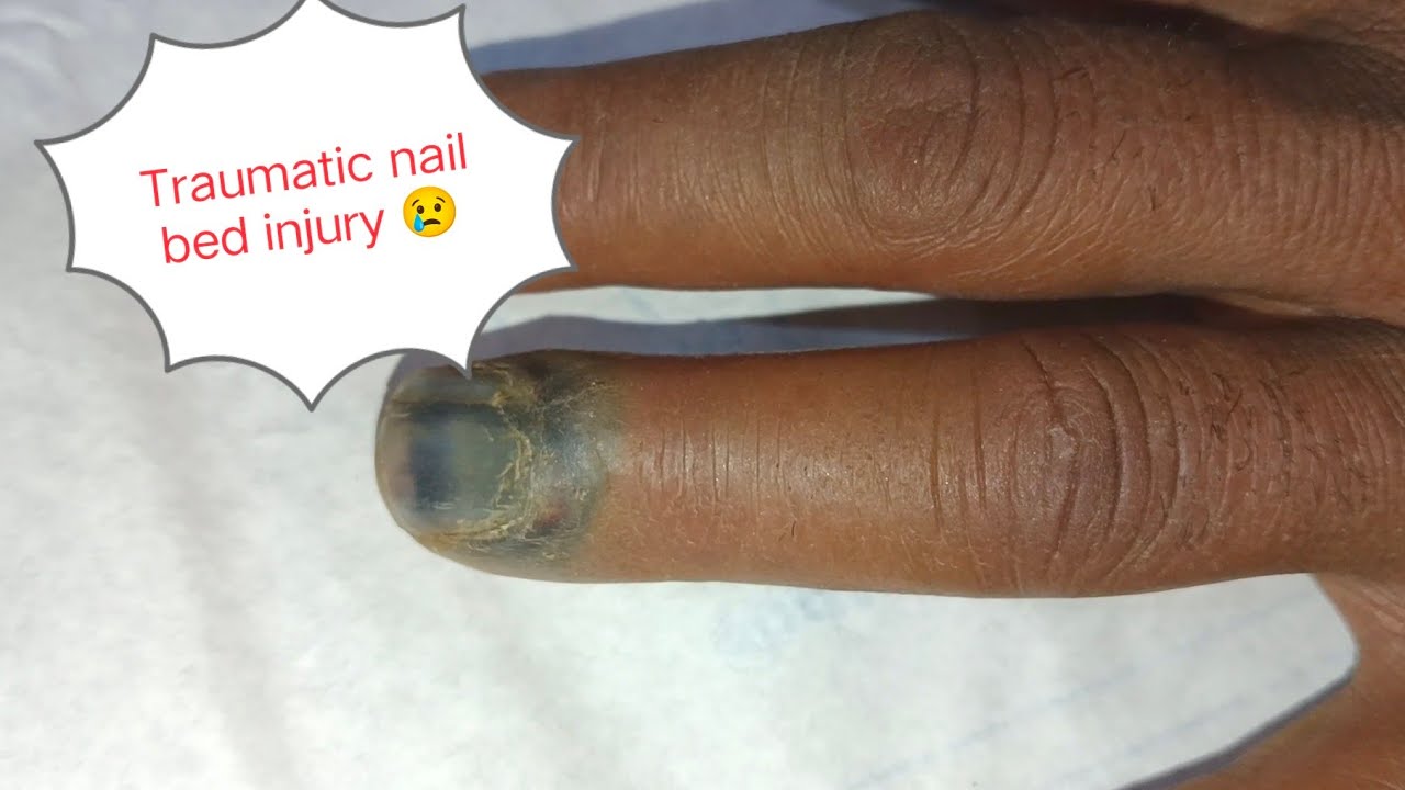 Nail Excision for Traumatic Injury: Clinical Demonstration - YouTube