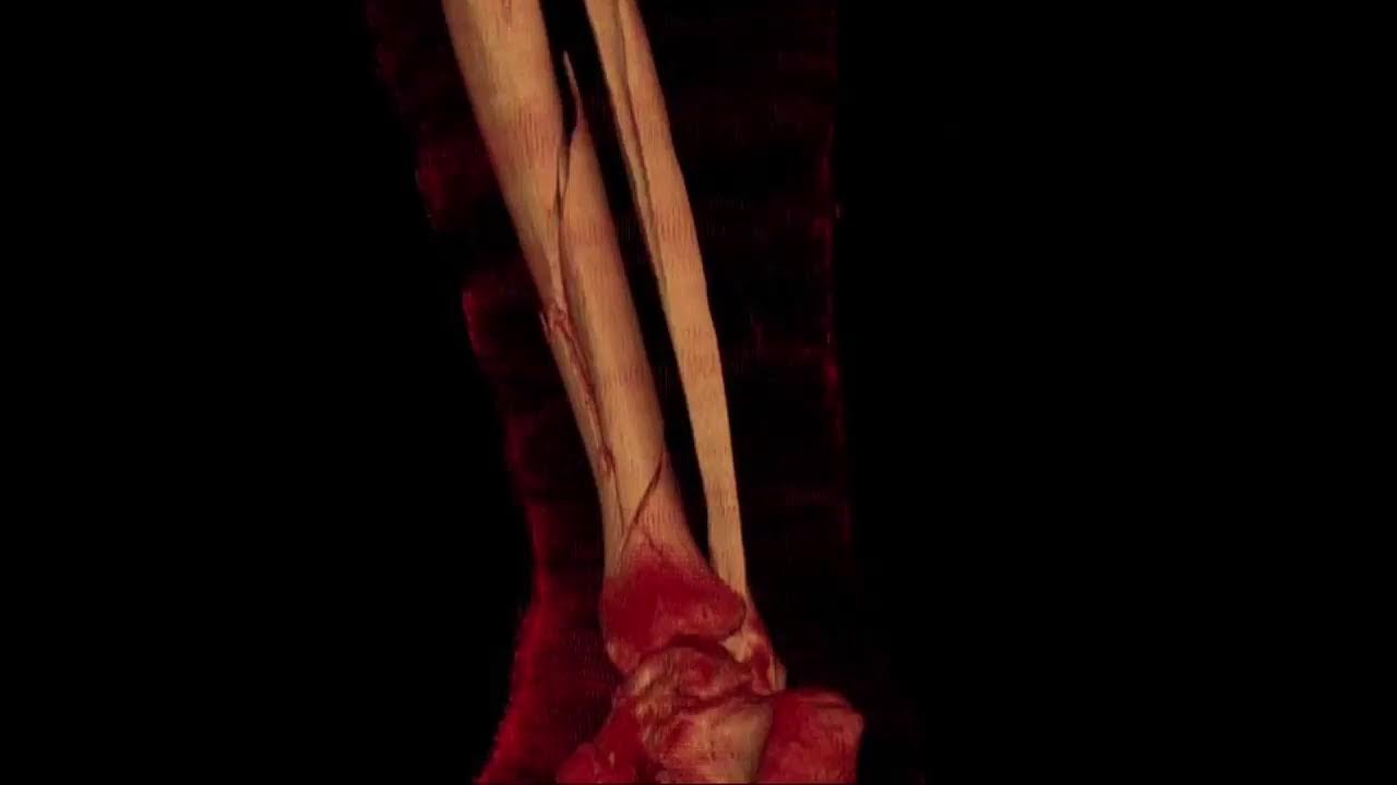 IV Fluids full explanation - YouTube