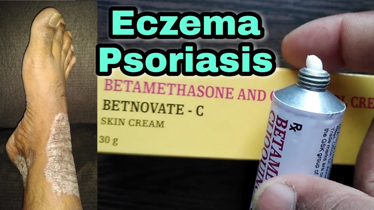 Eczema Psoriasis | Betnovate C Skin Cream - YouTube