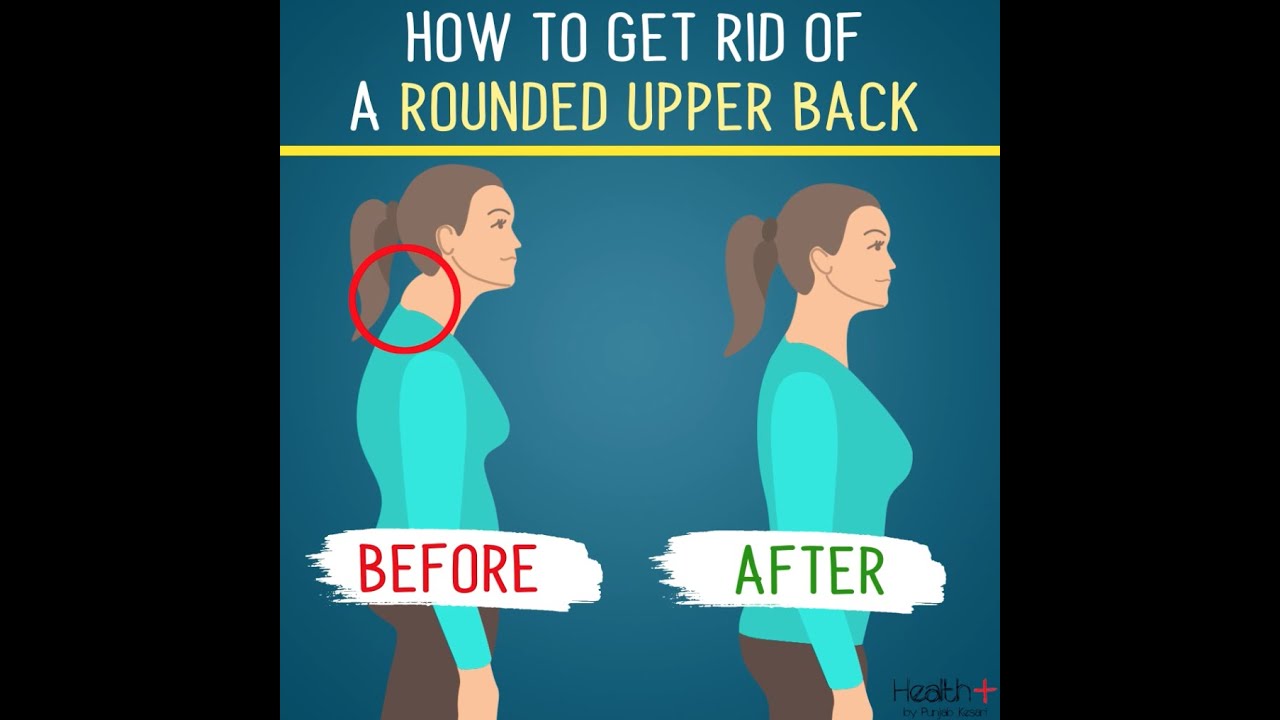 How To Get Rid Of A Rounded Upper Back - YouTube