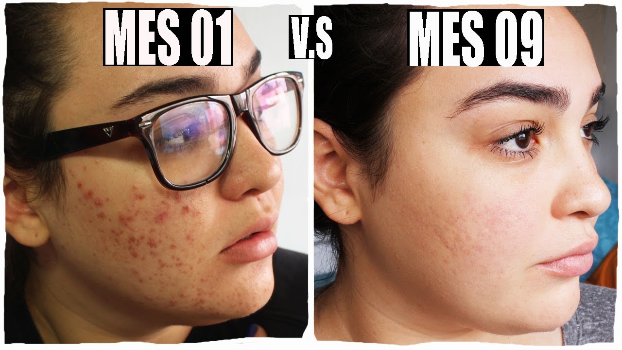 ¿CÓMO CURÉ MI ACNÉ? Resultados de Isotretinoína - Maquis Camargo - YouTube