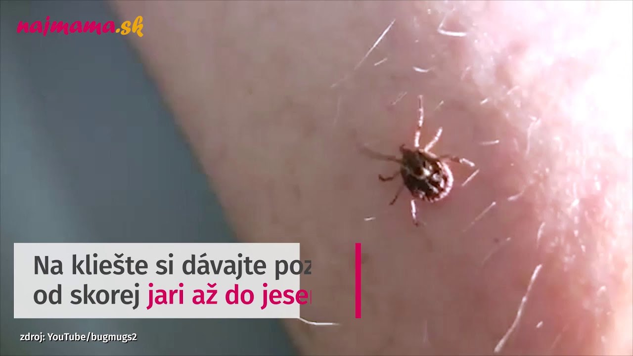 🩹 Ako správne vytiahnuť kliešťa? Názorné video | Aktuality - YouTube