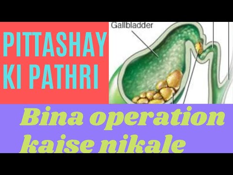 pittashay ki pathri bina opration kaise nikale - YouTube