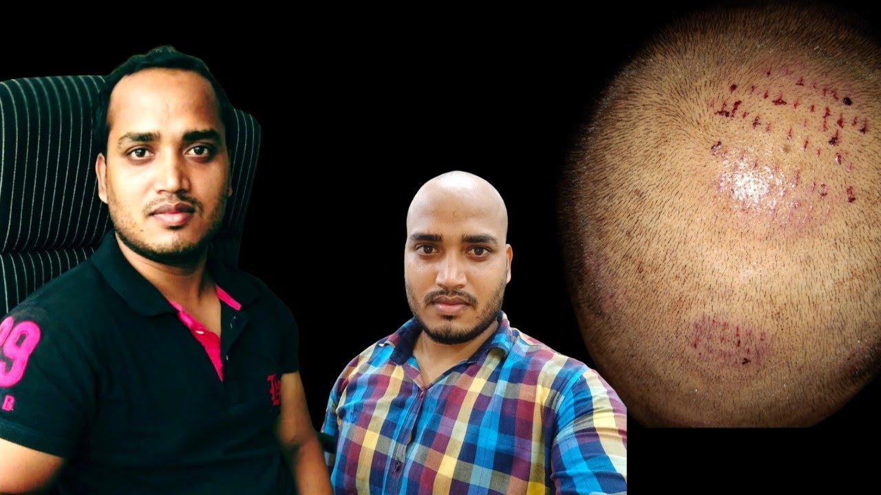 How To Regrow Hair How To Regrow Hair Naturally For Men बालों को