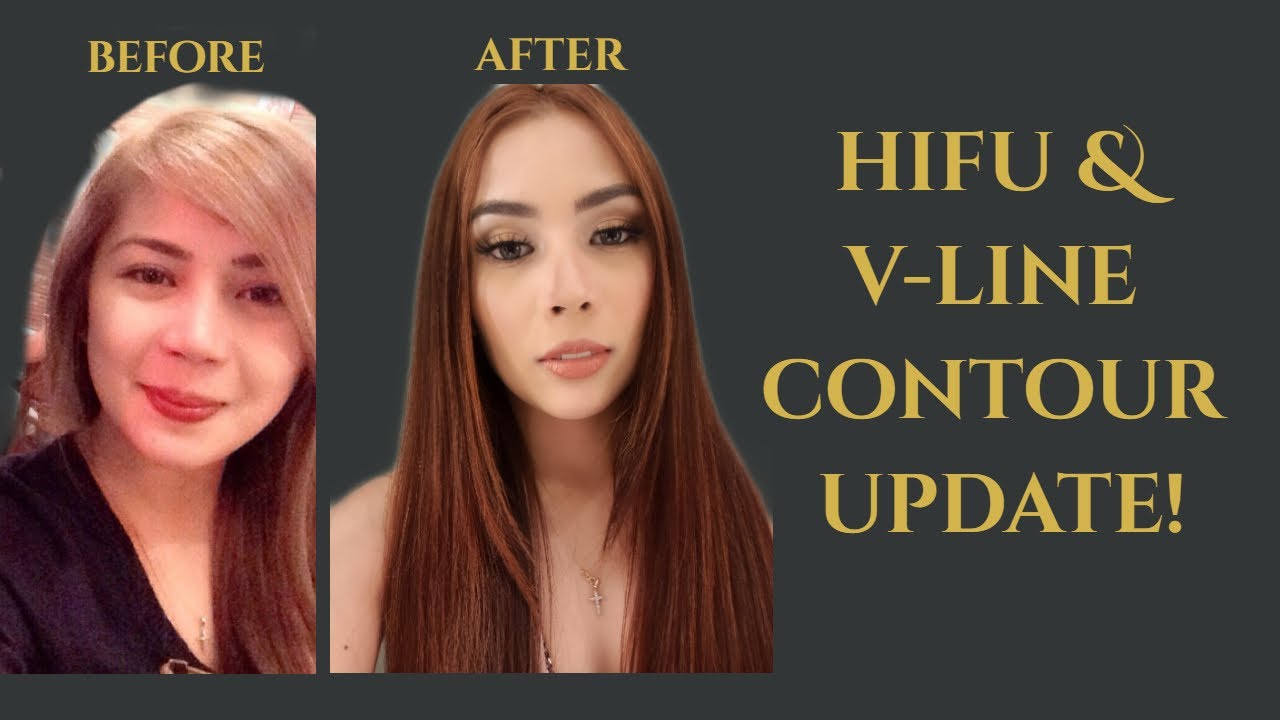 HIFU & V-LINE CONTOUR UPDATE! 4 MONTHS AFTER THE PROCEDURE! | Lavin Galicha - YouTube