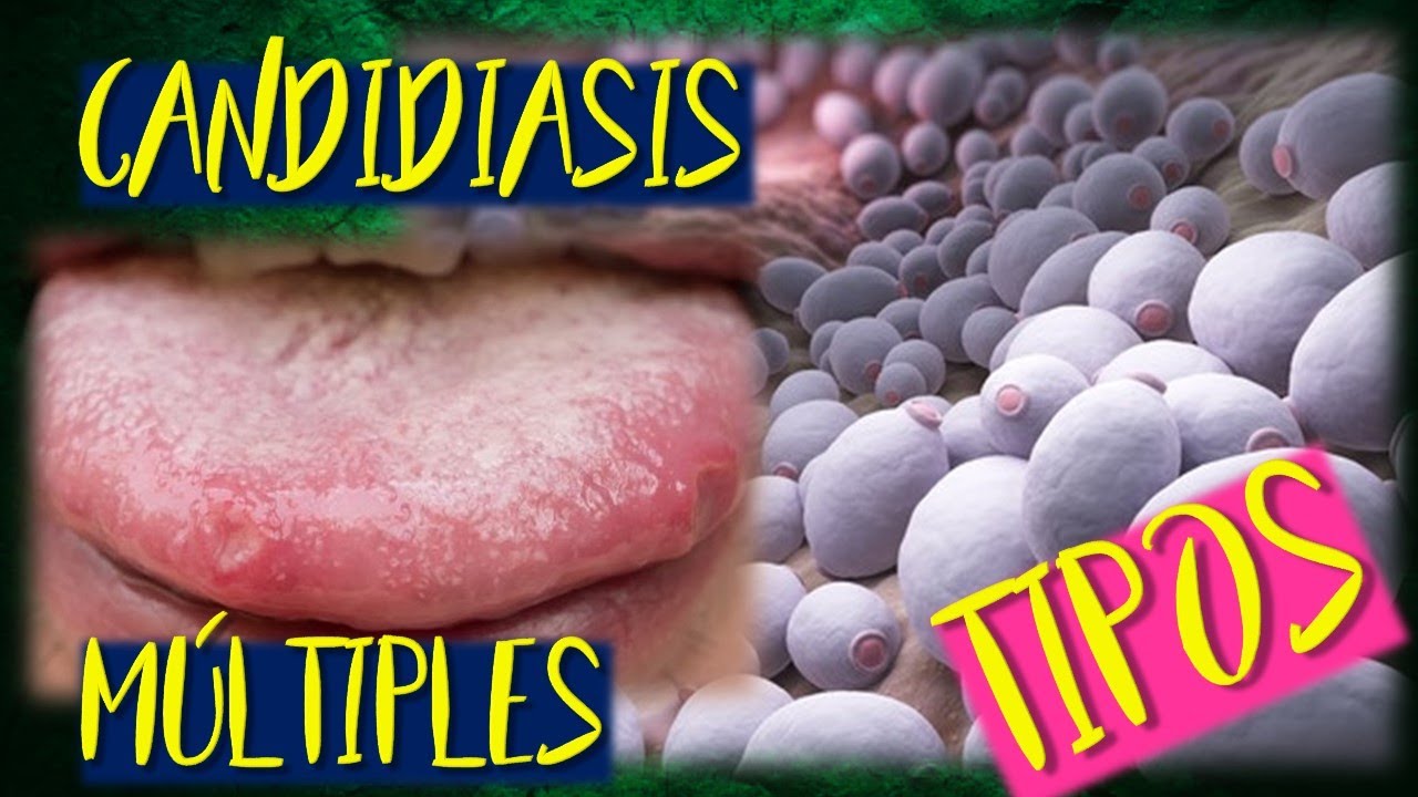 Candidiasis Todos sus tipos - YouTube