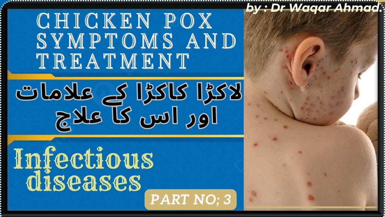 Chicken Pox Symptoms And Easy Treatment'/Infectious Diseases//(Part 3 ...
