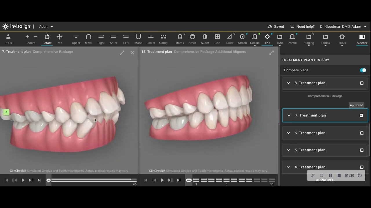 Extraction of four premolars using Inivsalign and no braces - YouTube