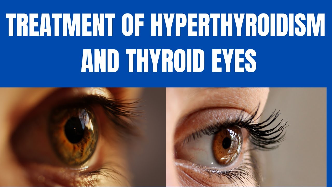 TREATMENT OF HYPERTHYROIDISM AND THYROID EYE DISEASE . - YouTube