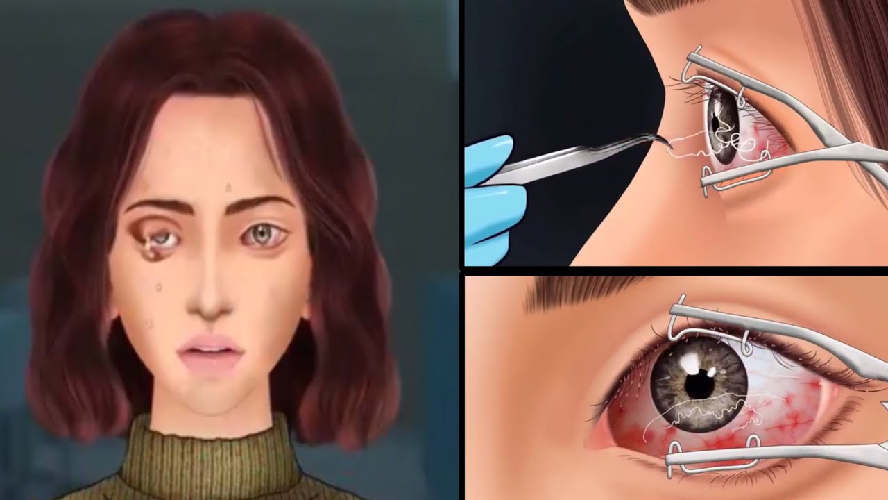 ASMR Treatment to remove secretion caused at eyes and Blackheads ...