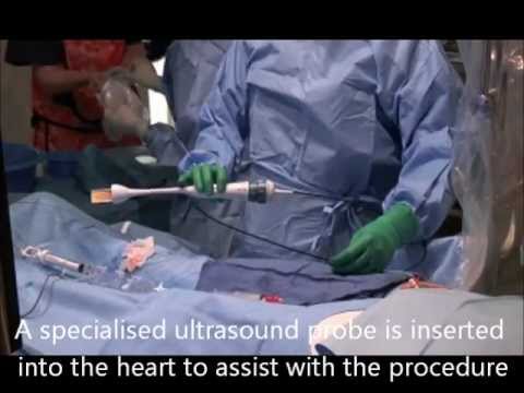 PFO closure - Premere. Sharpe Cardiology and Endovascular - YouTube
