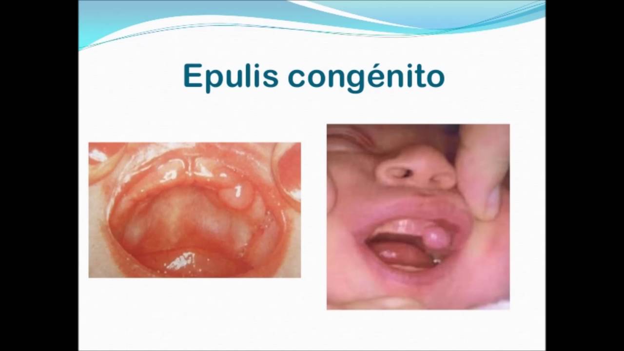 Épulis congénito - YouTube