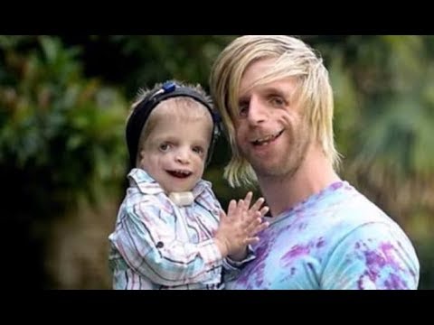 Man With Rare Deformity Shares Tearful Tale How And Why His Parents ...