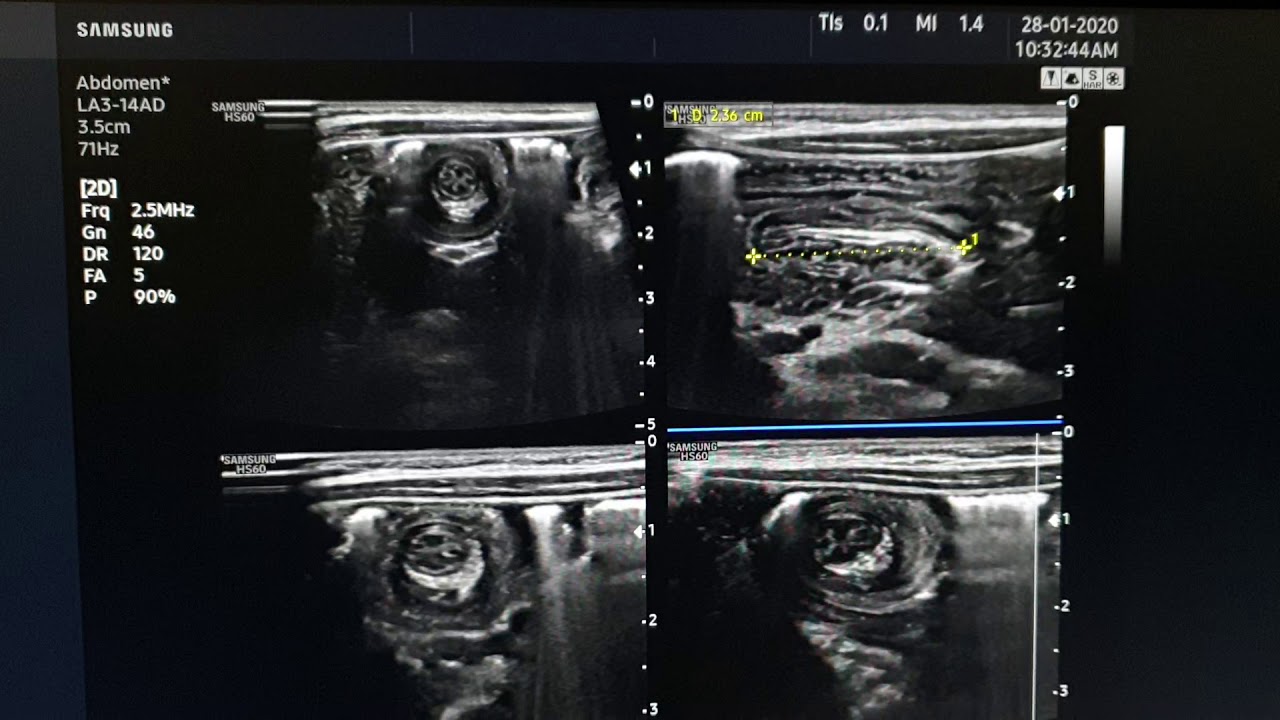 Intussusception Ultrasound - YouTube