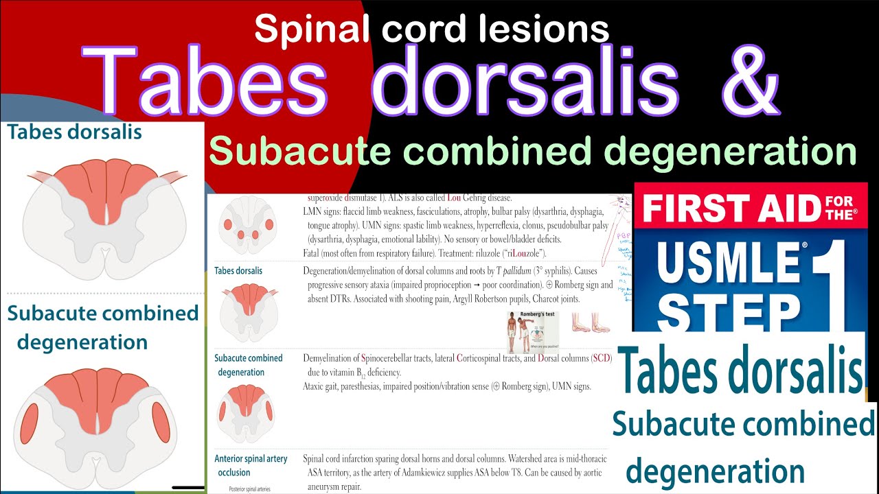 Tabes dorsalis & Subacute combined degeneration in Hindi/Urdu by first ...