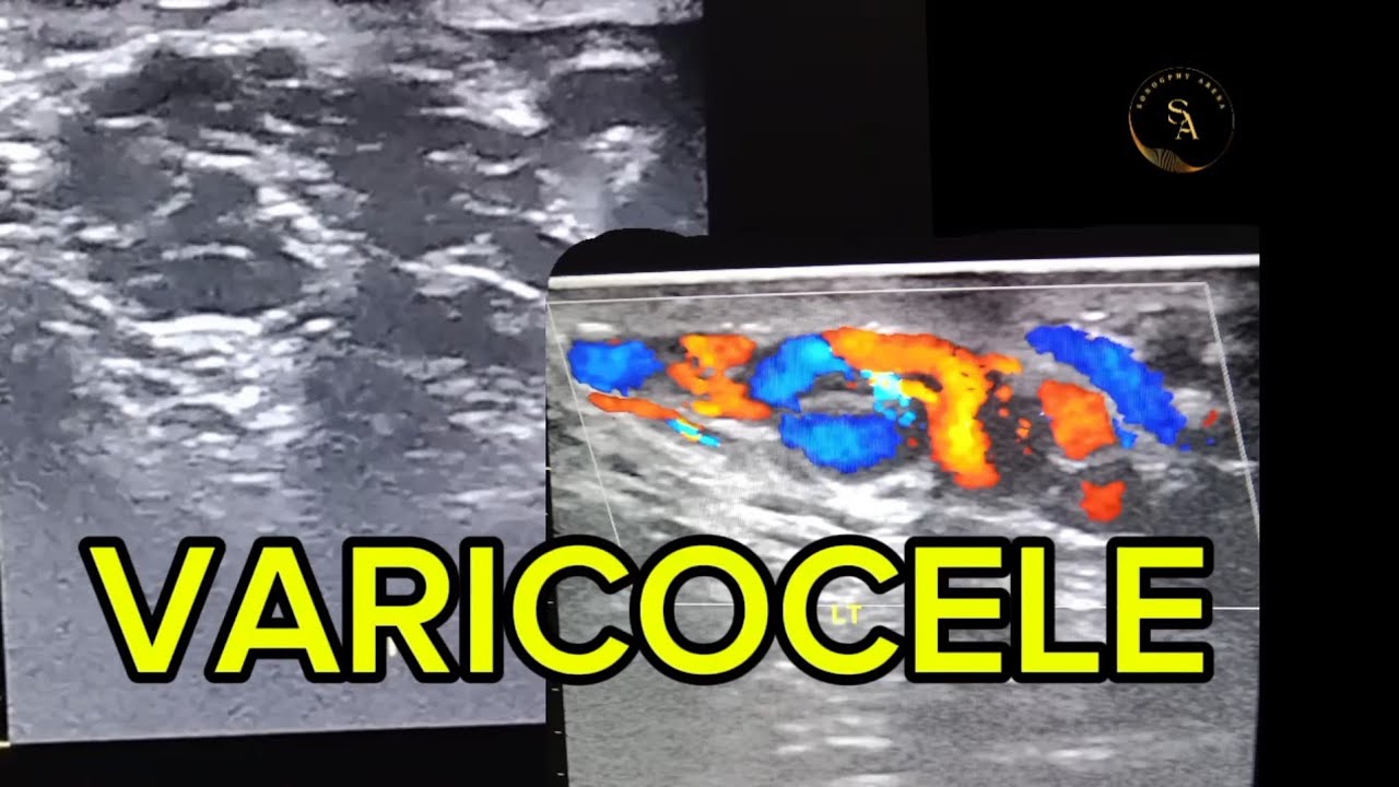 Ultrasound of varicocele. - YouTube