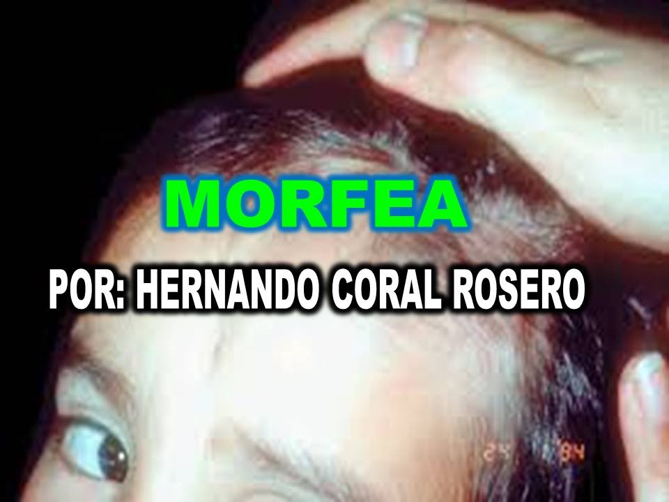 MORFEA ( ENGROSAMIENTO Y ENDURECIMIENTO DE LA PIEL ) - YouTube