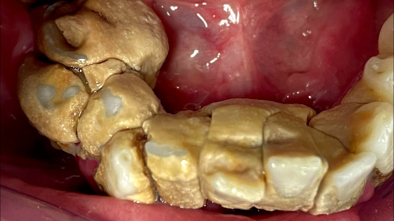 GIANT TARTAR CAME OUT WITH TEETH @GreatTeeth - YouTube