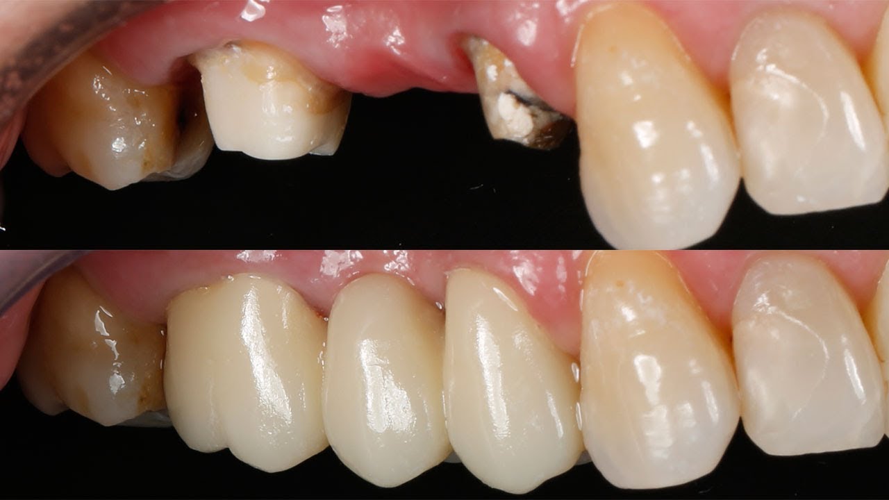 Ponte Fixa 3 Elementos - RETOEDU