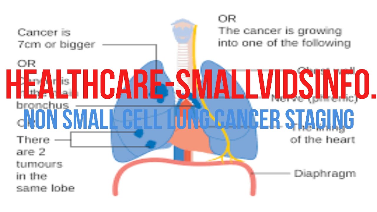 10 Tips to Master Non-Small Cell Lung Cancer Staging - YouTube