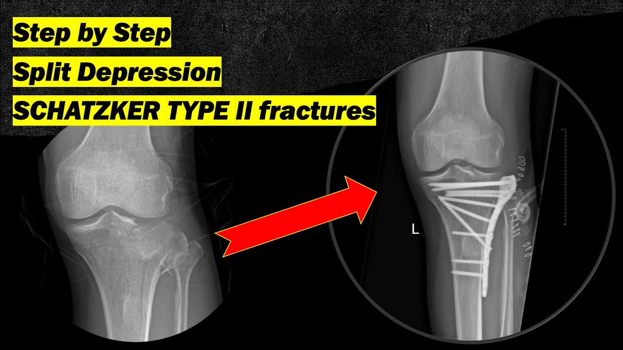 Step by Step Basics: Split Depression Tibial Plateau fractures (Graphic ...