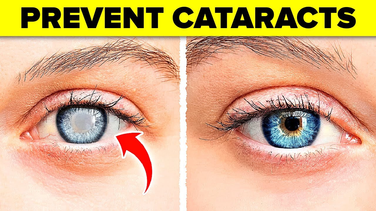 The Absolute BEST Way to Prevent Cataracts! - YouTube