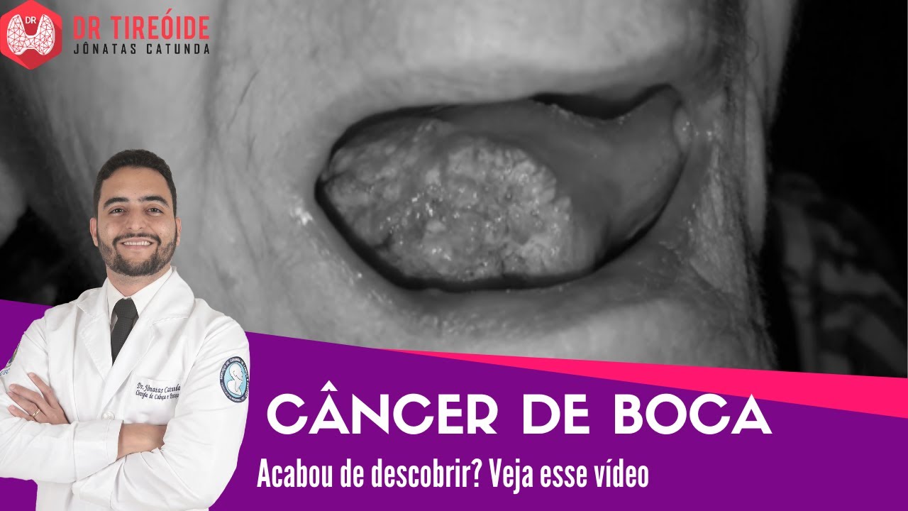Câncer de boca - Vídeo para quem acabou de descobrir! | Dr Jônatas ...