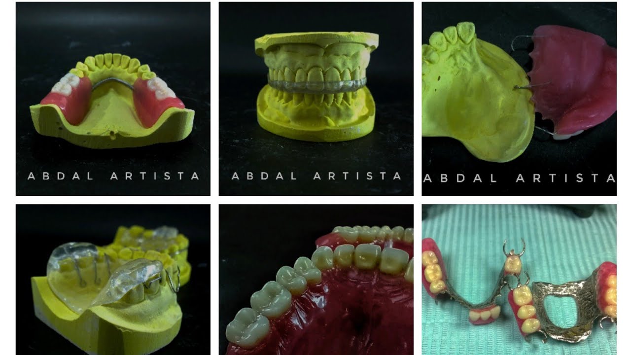 Work Projects | Complete Denture | Partial Denture | Obturator | Splint ...
