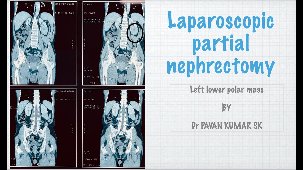 Laparoscopic partial nephrectomy for left lower polar mass - YouTube