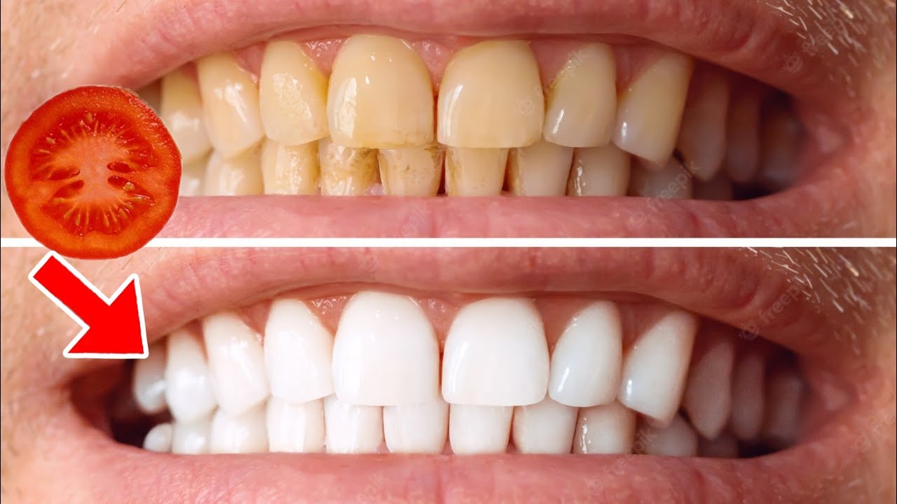 Teeth whitening at home in 2 minutes || Perfect Way To Have Shiny Teeth ...