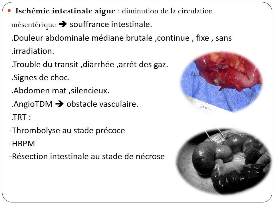 GASTRO-ENTEROLOGIE SYNDROME DOULOUREUX EPIGASTRIQUE - YouTube