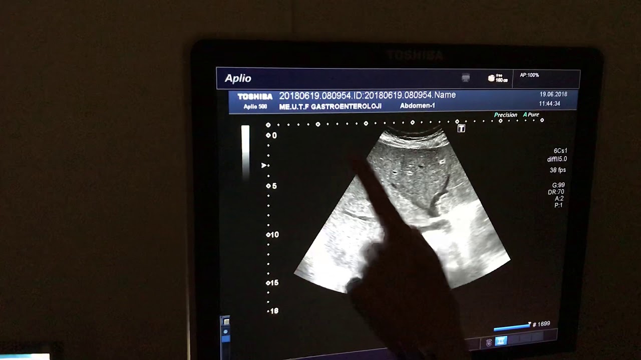 Karaciğer segmentleri, ultrasonografik olarak karaciğer parçaları ...