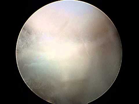 Arthroscopic Appearance of a Cranially Entrapped Medial Meniscus Tear ...