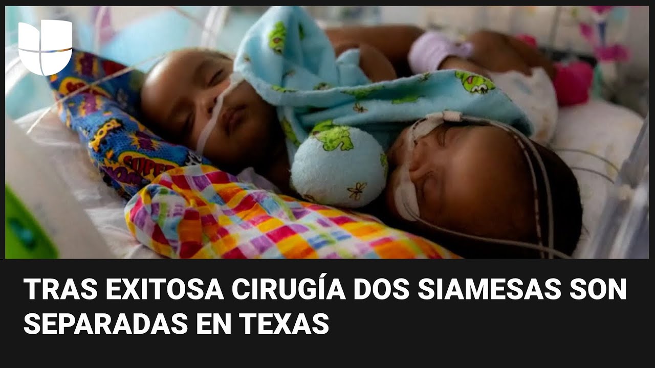 11 horas de cirugía y 50 médicos: logran separar con éxito a siamesas ...