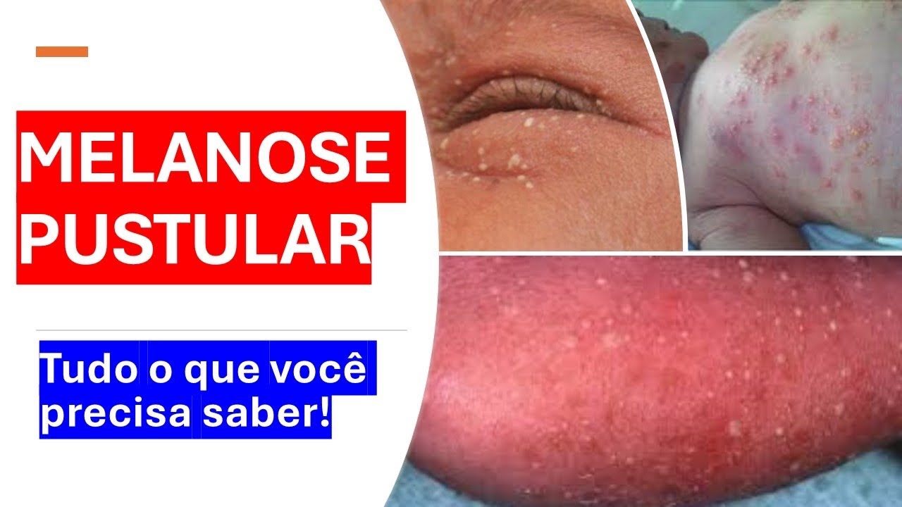 MELANOSE PUSTULAR , O que você precisa saber ? (Erupção Transitória do ...