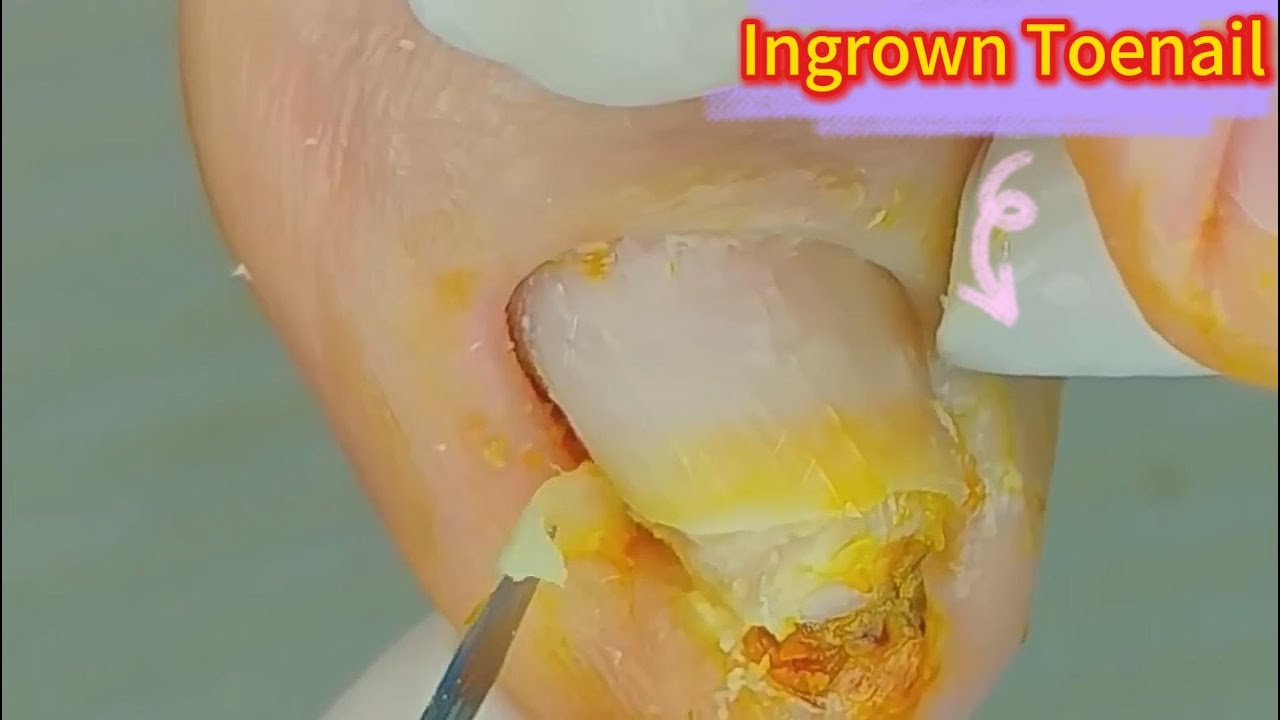 [ASMR] 32-Min Deep Ingrown Toenail & Dead Skin Removal Compilation ...