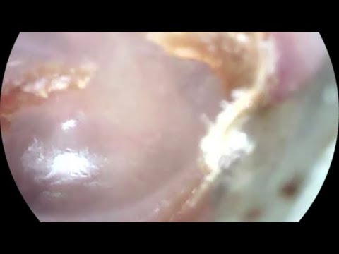 Ear Scraping - Finally got that dried flake out! - YouTube