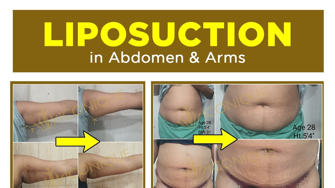 Arms & Abdomen Liposuction Surgery - Complete Fat Removal | Best ...