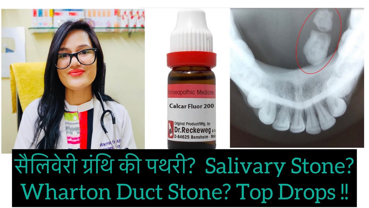 Salivary Gland’s Stone? सैलिवेरी ग्रंथि की पथरी?? Wharton Duct Stone ...