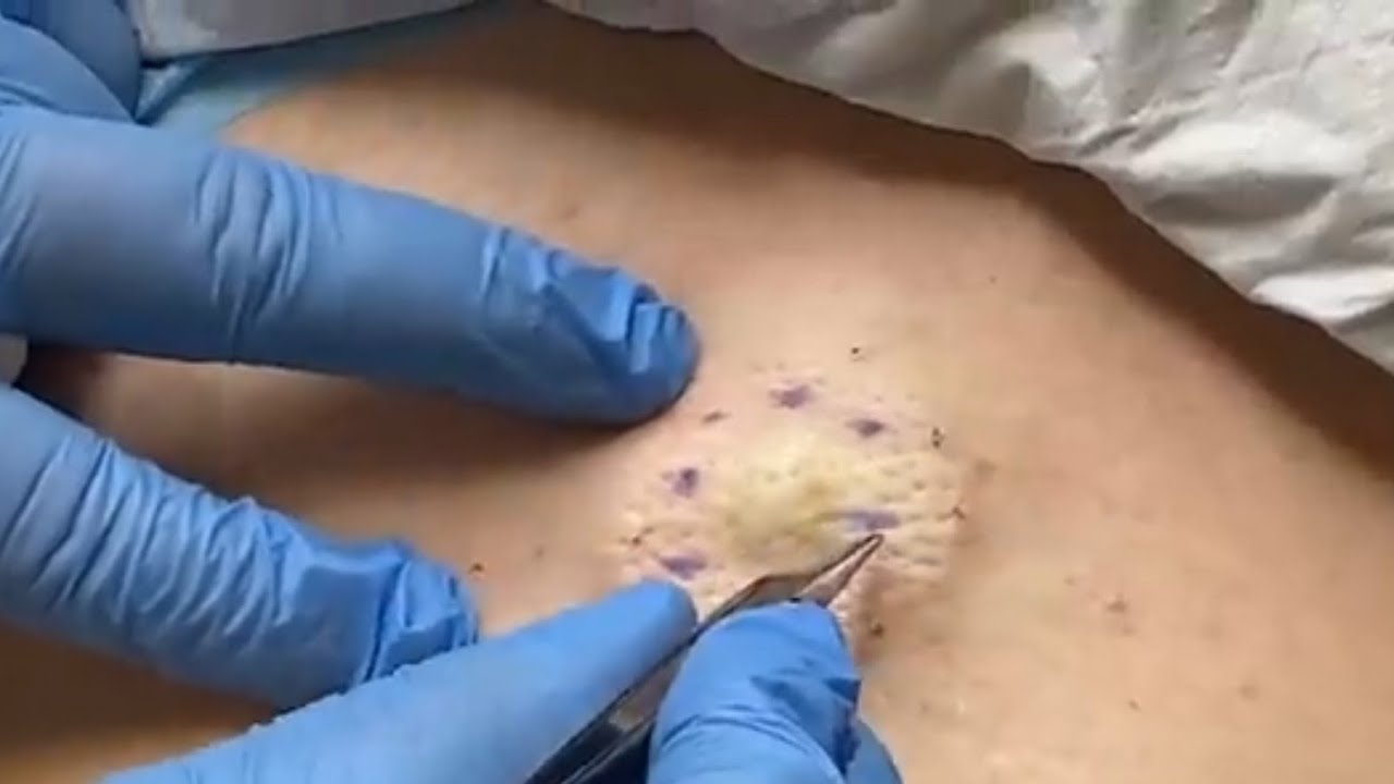 Removal of an epidermal cyst on the back - YouTube