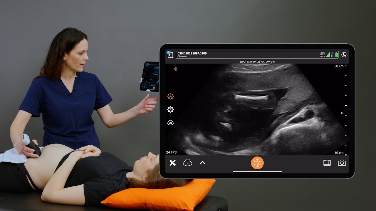 Femur Length Measurement - YouTube