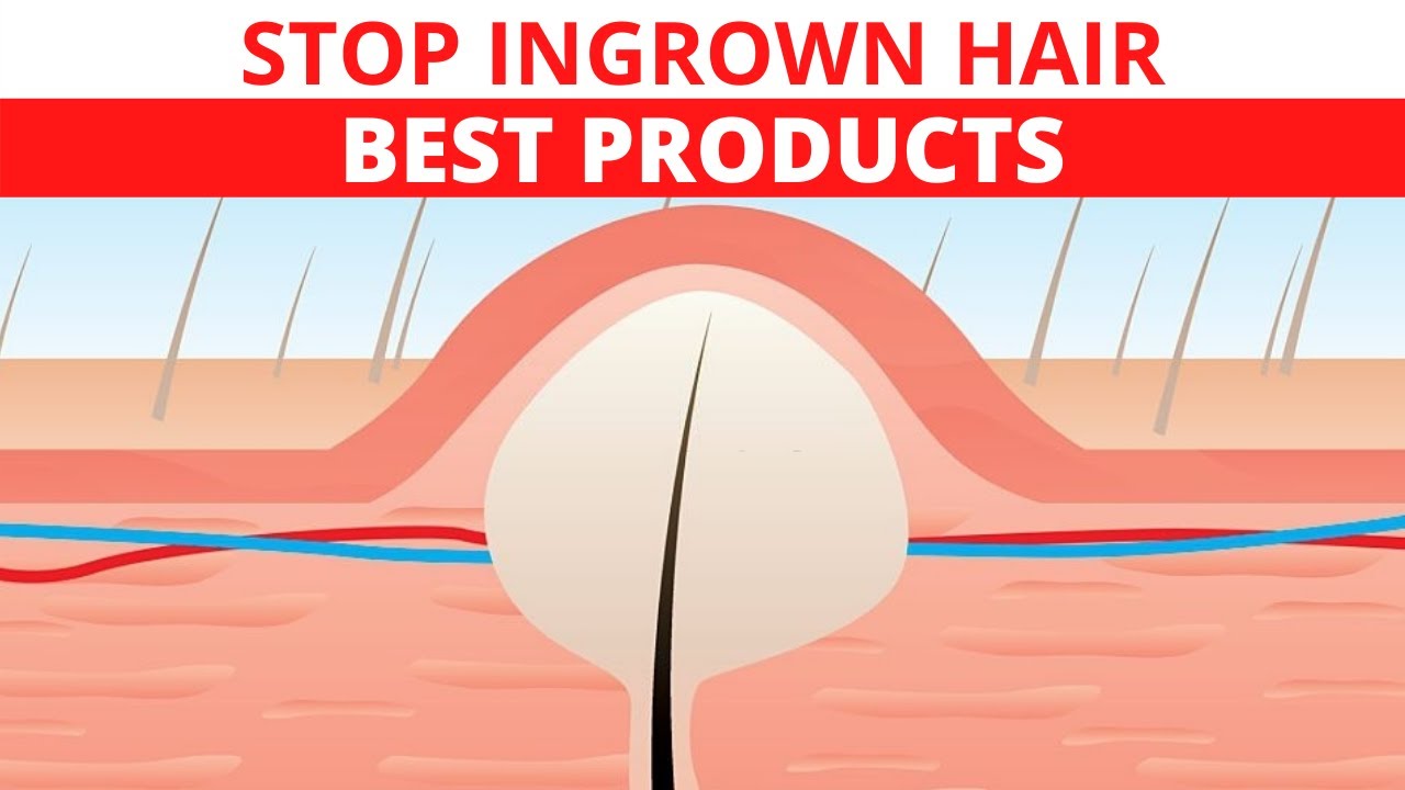 Stop Ingrown Hairs: BEST PRODUCTS - Razor Bumps, Irritation, Shaving ...