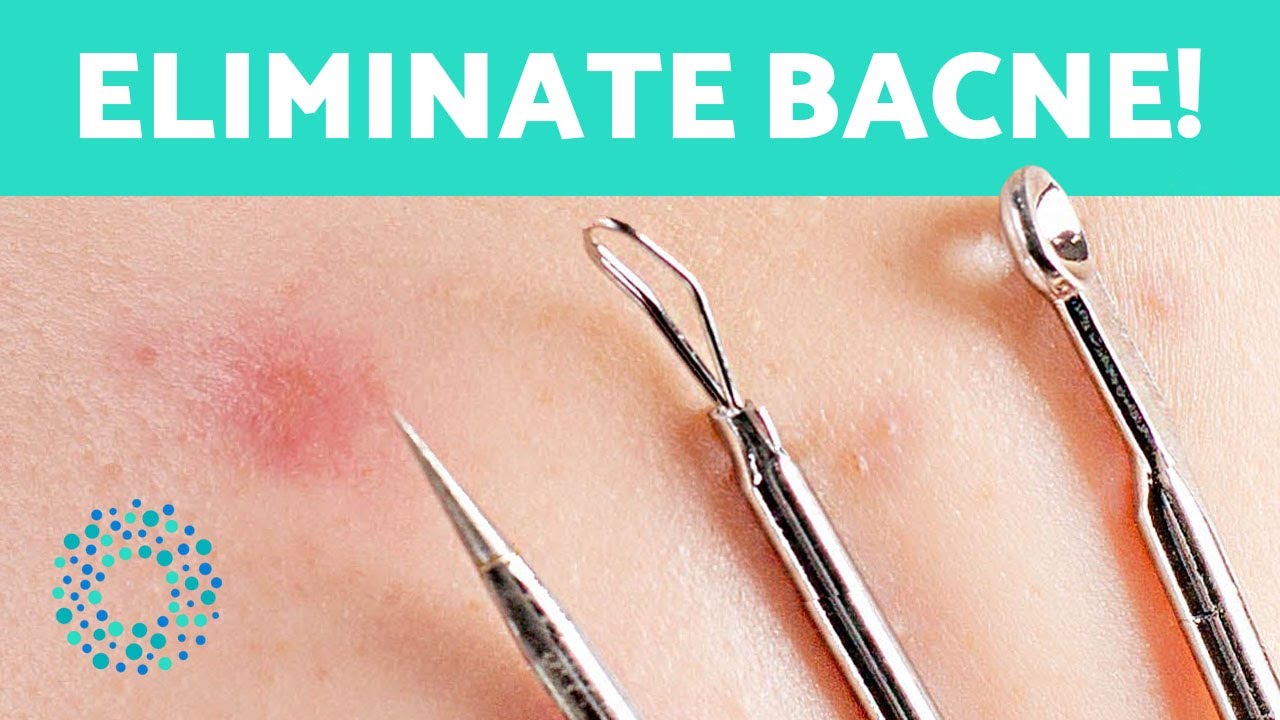 How To Get Rid Of Spots On Your Back 💥 Eliminate Bacne Youtube