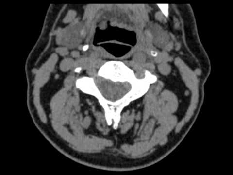 Hyoid bone - non-union of left greater cornu. - YouTube