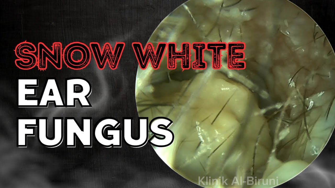 Snow White Ear Fungus Infestation - YouTube